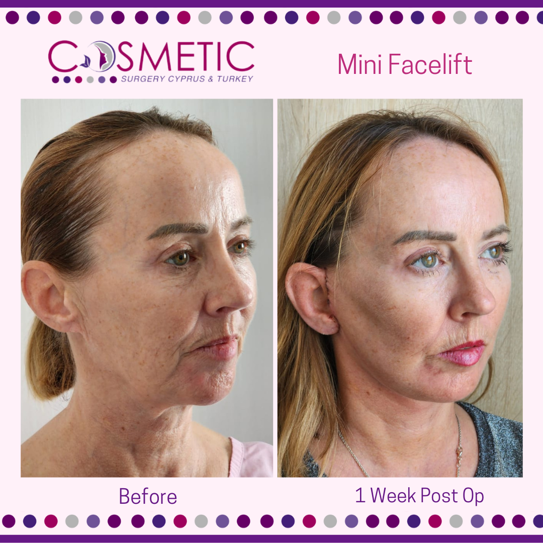 Facelift vs. Mini Facelift in Cyprus & Turkey - Cosmetic Surgery Cyprus